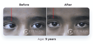 Gallery - Eye Align