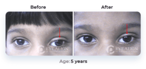 Gallery - Eye Align